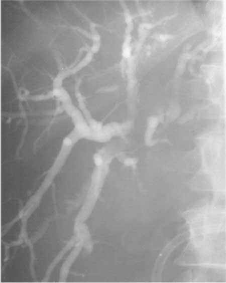 Brazilian Journal of Videoendoscopic Surgery - CASE REPORT